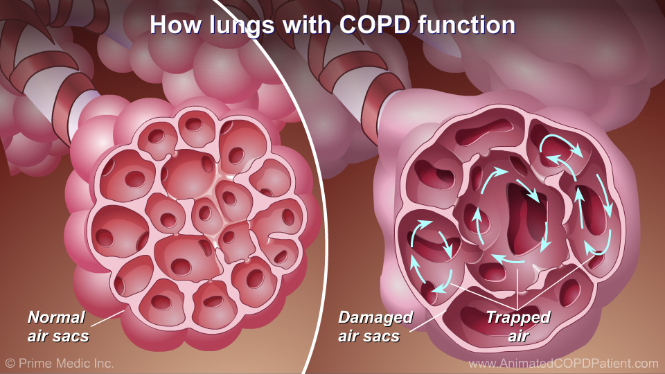 Emphysema Lung Slide